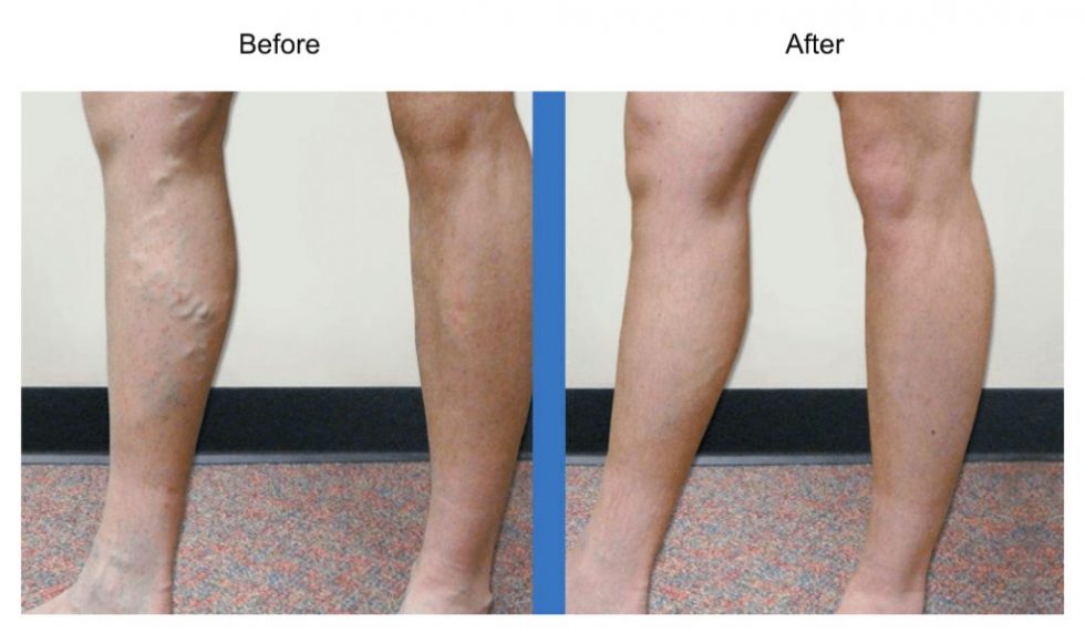 What to Expect From Sclerotherapy - Vein Specialists of the Carolinas