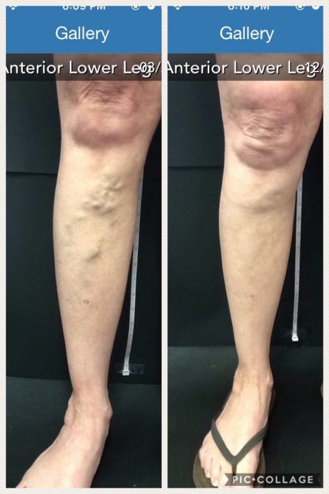 Before And After Vein Treatments Vein Specialists Of The Carolinas