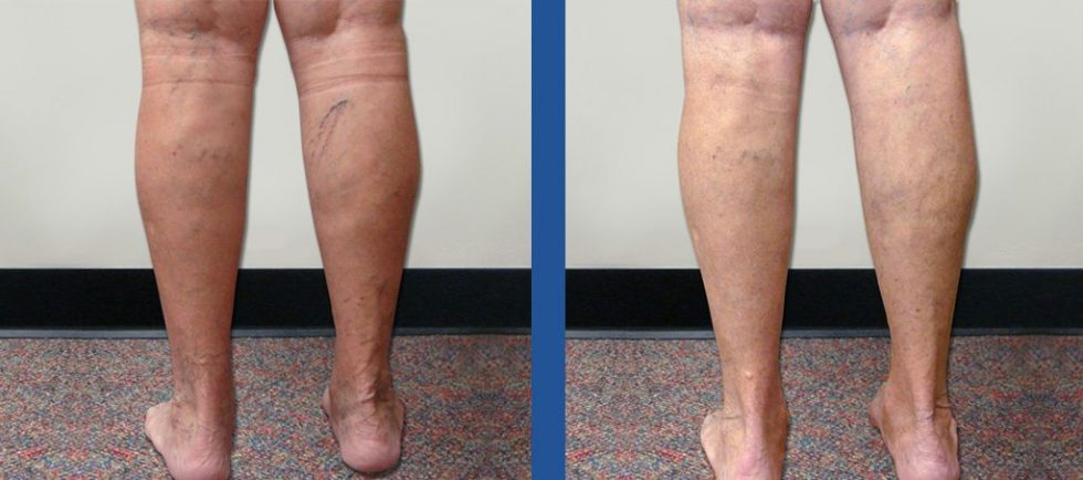 Before and After Vein Treatments - Vein Specialists of the Carolinas