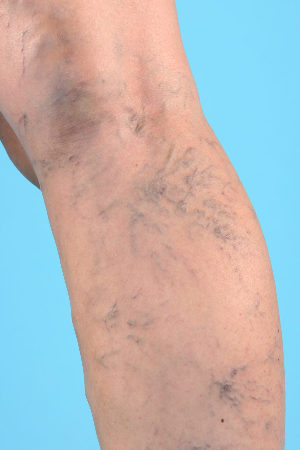 Vein Disorders - Vein Specialists of the Carolinas - "All We Do Is ...