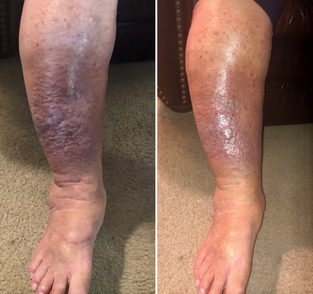 Lymphedema Vein Disorder Vein Specialists Of The Carolinas Lymphedema Vein Disorder Vein Specialists Of The Carolinas
