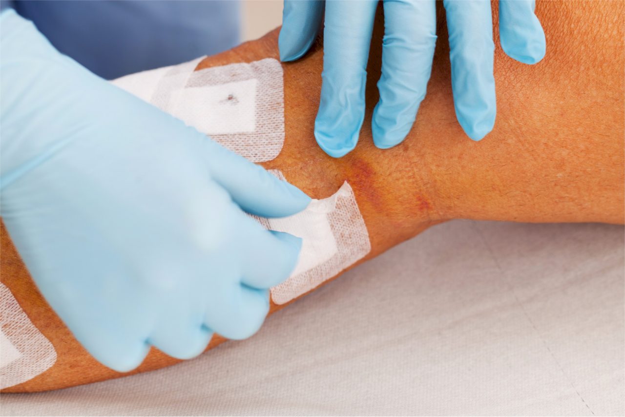 Microphlebectomy - Vein Specialists of the Carolinas