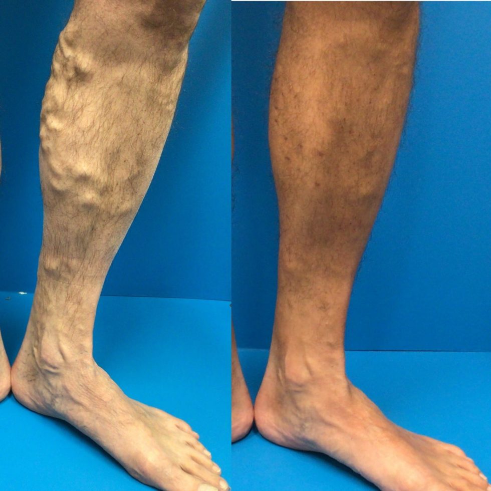 Phlebectomy Archives Vein Specialists Of The Carolinas