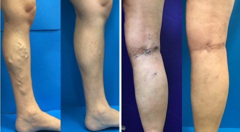 You Know It’s Time To See a Doctor About Your Veins When... - Vein ...