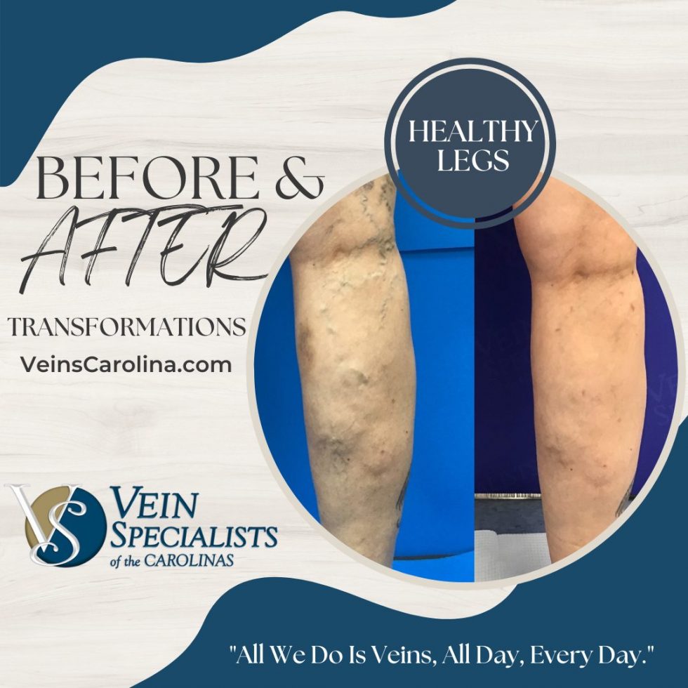 Before After Leg Transformations Vein Specialists Of The Carolinas
