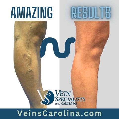 Amazing Results! Leg Transformations by VSC. - Vein Specialists of the ...