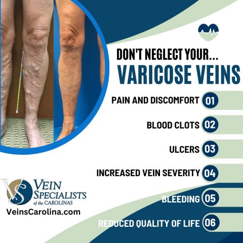 Why Is It Important to Treat Your Varicose Veins? - Vein Specialists of ...