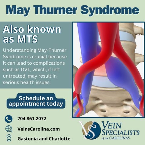 Understanding May Thurner Syndrome: A Closer Look - Vein Specialists of ...