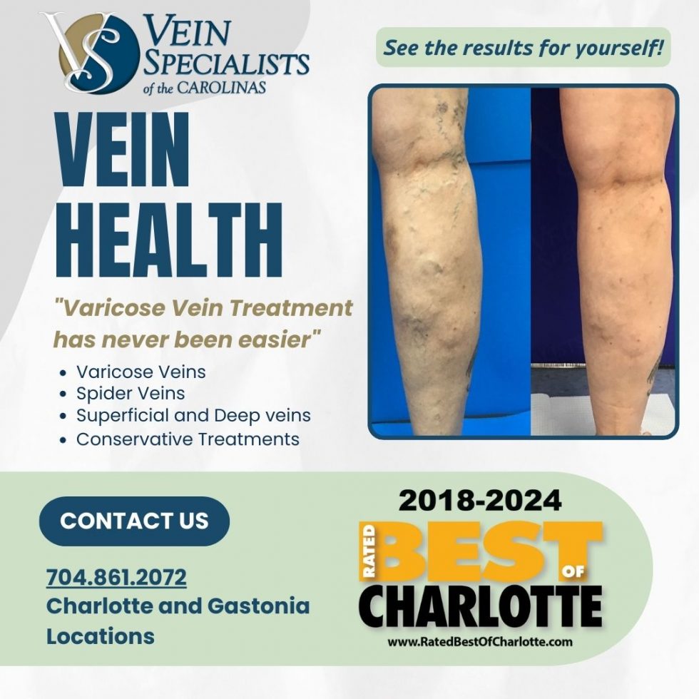 7 FAQ's - Understanding and Managing Varicose and Spider Veins - Vein ...