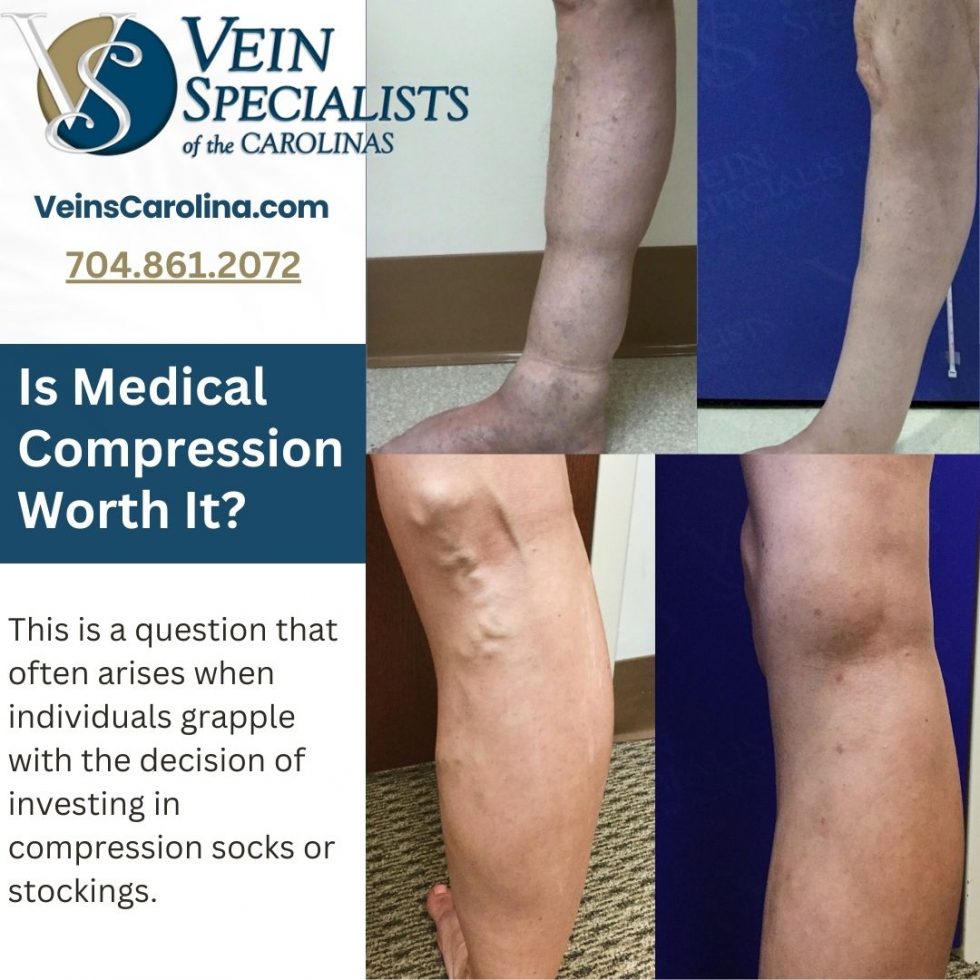 The Benefits Of Medical Grade Compression In Treating Chronic Venous