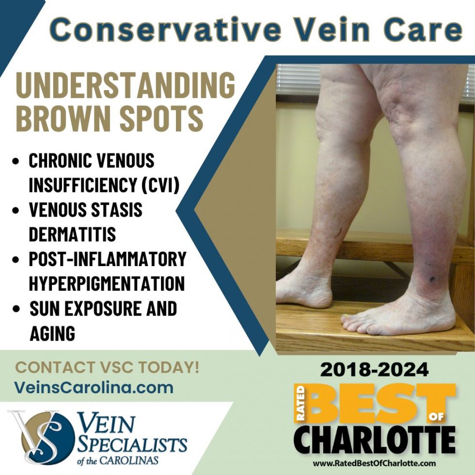 Understanding and Treating Brown Spots on Legs - VSC