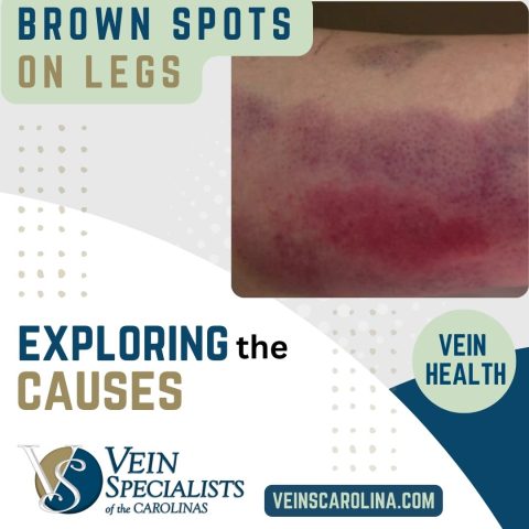 Understanding Brown Spots on Legs: Causes and Treatments - Vein ...