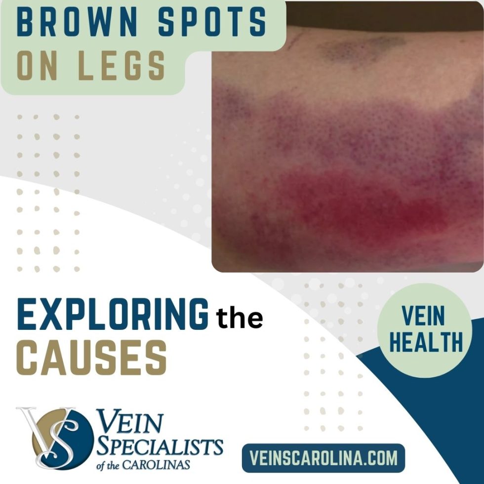 Understanding Brown Spots on Legs: Causes and Treatments - Vein ...